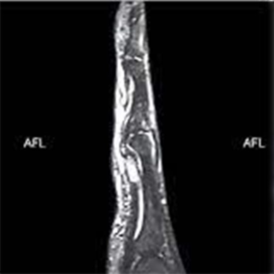 MRI Right Middle Finger | Test Price in Delhi | Ganesh Diagnostic