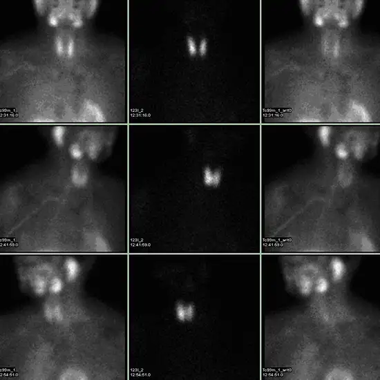 Sestamibi (MIBI) scan | Test Price In Delhi | Cost Near Me, India ...