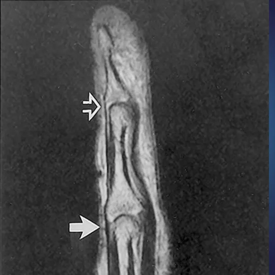 MRI Index Finger Test Near You in Delhi | Book Test at Low Price