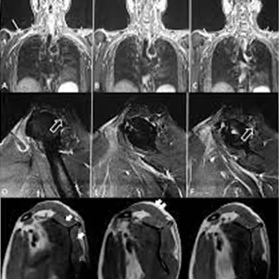 MRI Screening Right Parascapular | Test Price in Delhi | Ganesh Diagnostic