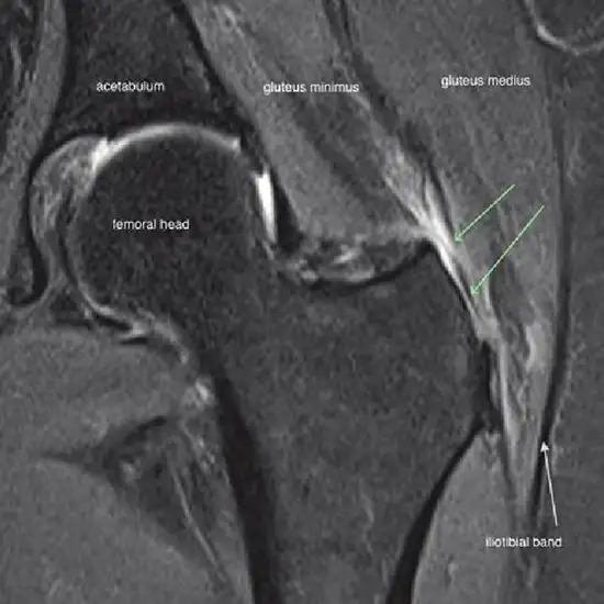 MRI Gluteal & Spine | Test Price in Delhi | Ganesh Diagnostic