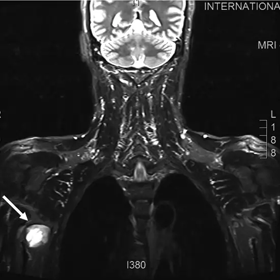 MRI Axilla Right | Test Price in Delhi | Ganesh Diagnostic