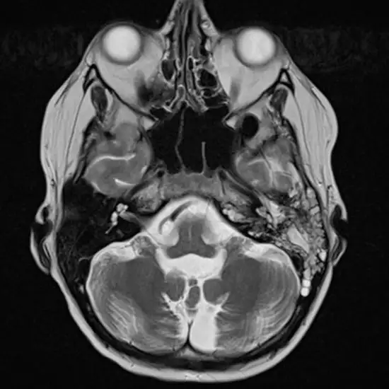 MRI Mastoid | Test Price in Delhi | Ganesh Diagnostic