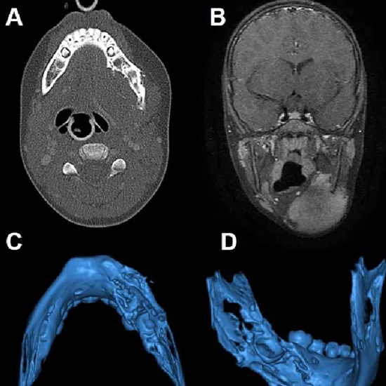 MRI Screening Mandible | Test Price in Delhi | Ganesh Diagnostic