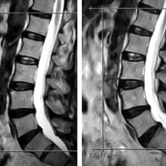 MRI LS Spine Axial Cuts Scan Cost in Delhi Price Near Me India | Ganesh ...