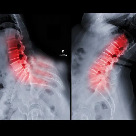 MRI LS Spine Flexion | Test Price in Delhi | Ganesh Diagnostic