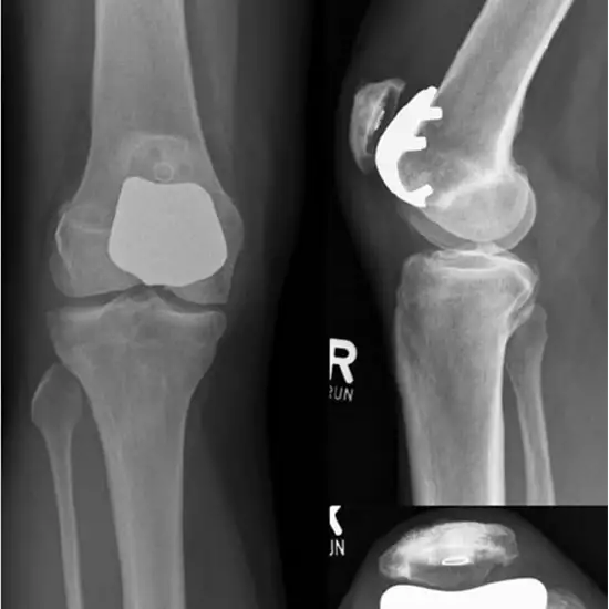 X-ray Both Knee Merchant View | Test Price in Delhi | Ganesh Diagnostic