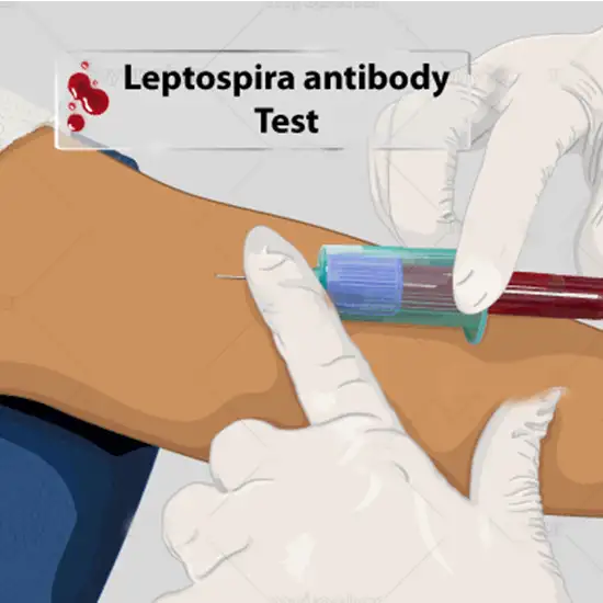 Leptospira Antibody IGM Test Near You in Delhi | Book Test at Low Price