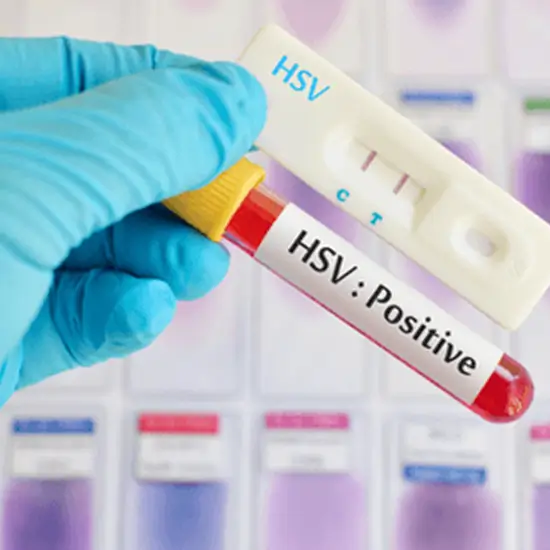 Herpes Simplex Virus (HSV) IgG Test Near You in Delhi | Book Test at ...