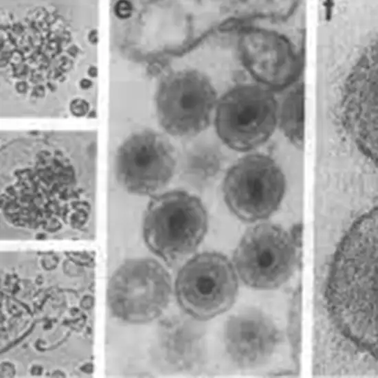 Human Herpes Virus 7 Qualitative PCR Cost in Delhi Test Price Near Me ...