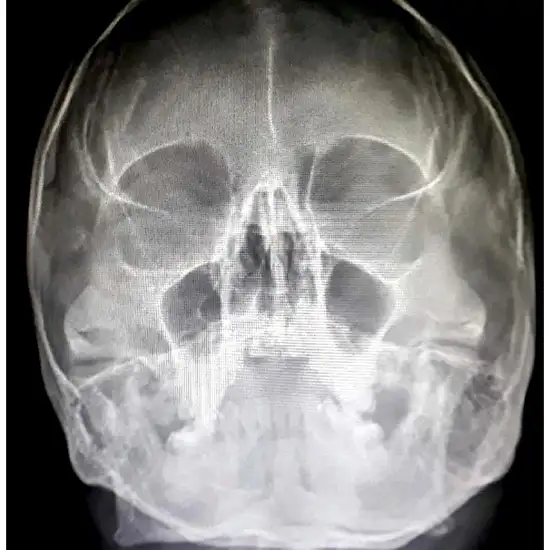 PNS X ray AP Lateral View Test Price In Delhi Ganesh Diagnostic PNS X ray AP Lateral View Test Price In Delhi Ganesh Diagnostic
