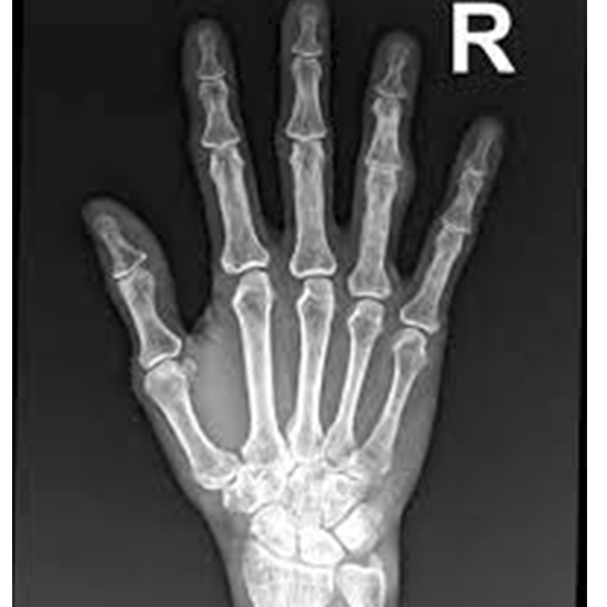 X-ray Left Ring Finger | Test Price in Delhi | Ganesh Diagnostic