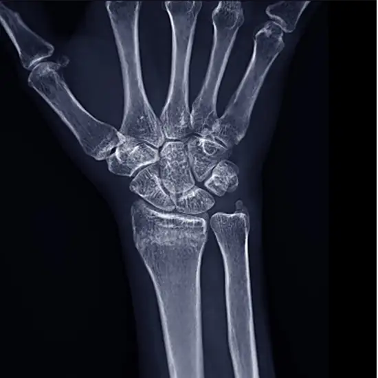 X-ray Right Wrist AP/LAT | Test Price in Delhi | Ganesh Diagnostic