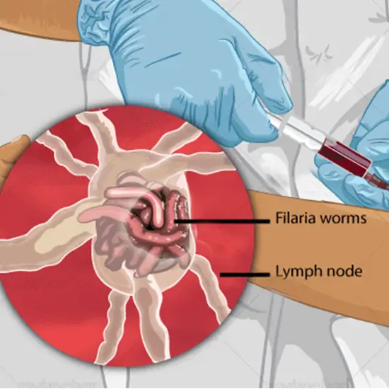 Microfilaria Antigen Test Near You in Delhi | Book Test at Low Price