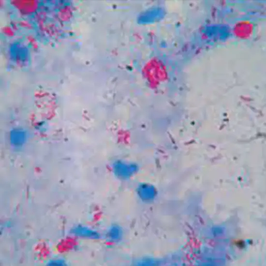 Slit Skin Smear-AFB | Test Price In Delhi | Cost Near Me, India ...