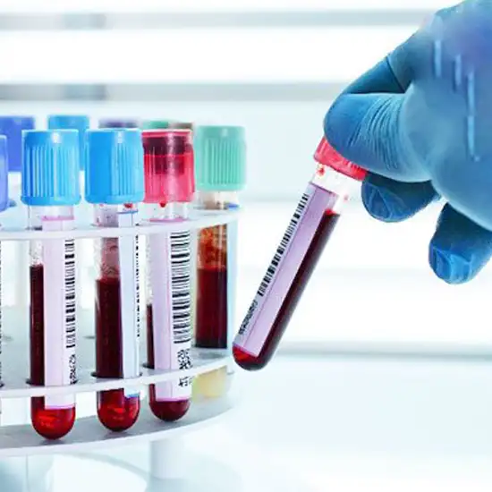 ANTI DNA AB.(DS) (EIA) | Test Price in Delhi | Ganesh Diagnostic