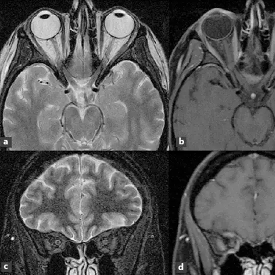MRI Orbit With Contrast | Test Price in Delhi | Ganesh Diagnostic