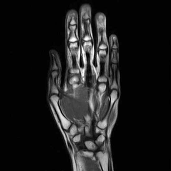 MRI Palm | Test Price in Delhi | Ganesh Diagnostic