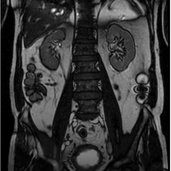 MRI Screening Of KUB | Test Price in Delhi | Ganesh Diagnostic