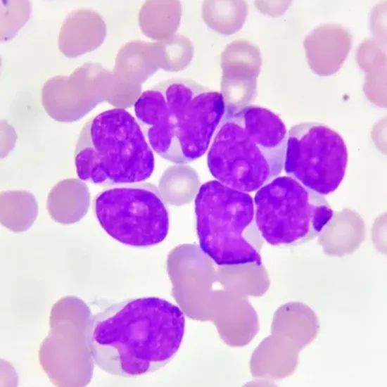 Book AML Categorization Prognosis | Test Price In Delhi | Ganesh Diagnostic