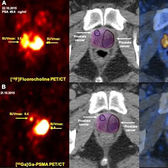 PSMA PET-CT Scan for Prostate - PSMA For Prostate Cancer