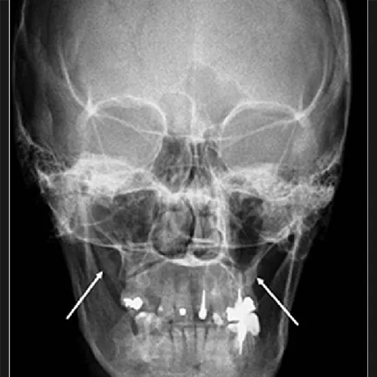 X-ray Skull Townes View Procedure in Detail - Ganesh Diagnostic