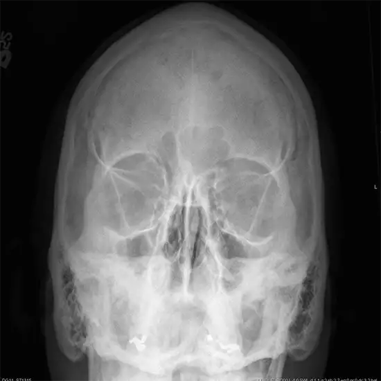 Know X-Ray Skull Caldwell view Procedure - Ganesh Diagnostic