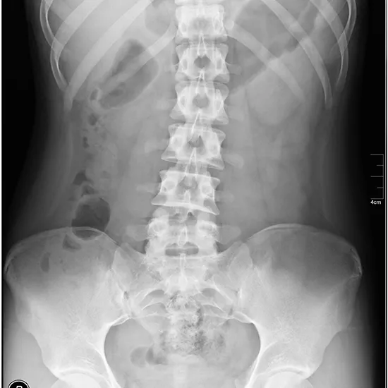 X-RAY ABDOMEN ERECT AND SUPINE VIEW PROCEDURE