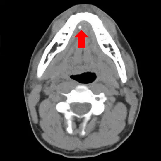 CT Parotid Cost in Yamuna Vihar Test Price Near Me India | GDIC