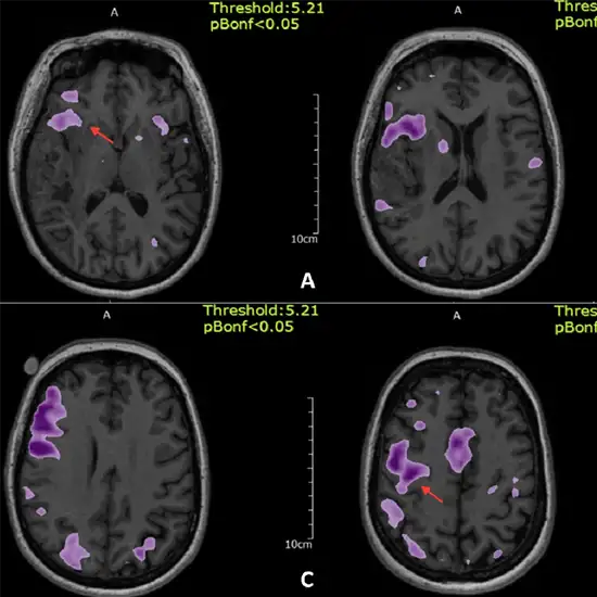 Procedure of Functional MRI - Ganesh Diagnostic