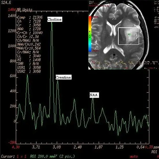 Get MR Spectroscopy Procedure - Ganesh Diagnostic