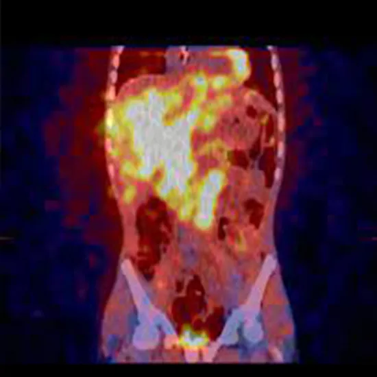 MIBG Scan Procedure - Ganesh Diagnostic