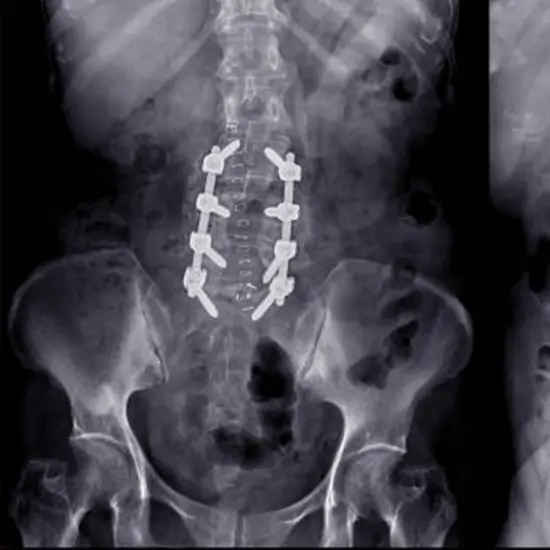 Get X-Ray Lsspine Ap/Lateral View Procedure - Ganesh Diagnostic