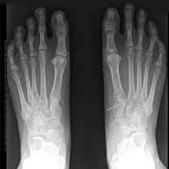 Best X-Ray Both Feet Ap View - Ganesh Diagnostic