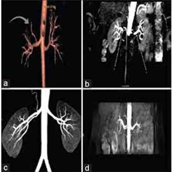 CT Renal Angiography Test