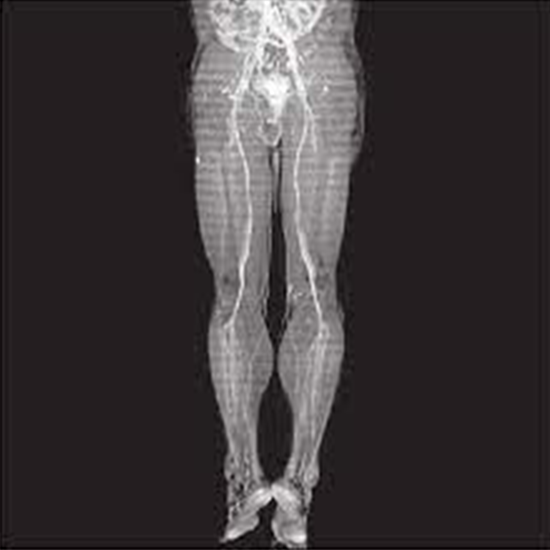 CT Lower Limb Angiography Test Price- Cost in Yamuna Vihar - Ganesh ...