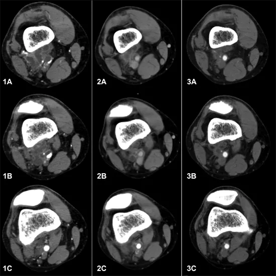 CECT Left Ankle Joint Test Cost - Price in Yamuna Vihar
