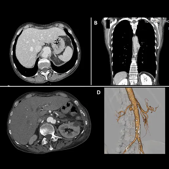 CT Abdominal Aorta Test Cost in Yamuna Vihar - Ganesh Diagnostic