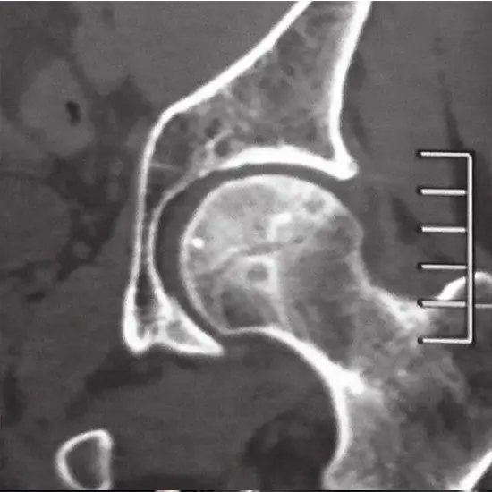 CT scan Hip Joint Test Price - Best Prices- Ganesh Diagnostic