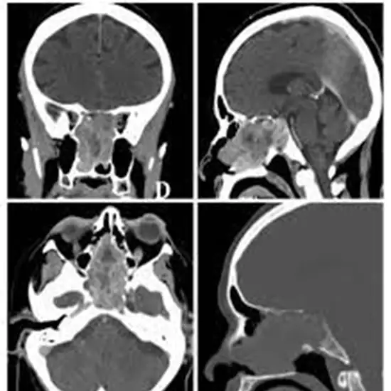 CECT Pituitary Sella Test