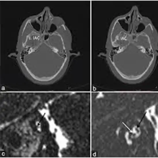 Internal Auditory Canal CT scan - Ganesh Diagnostic