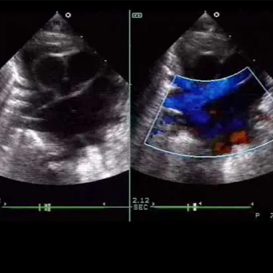 Pediatric Echocardiography Procedre in Detail - Ganesh Diagnostic