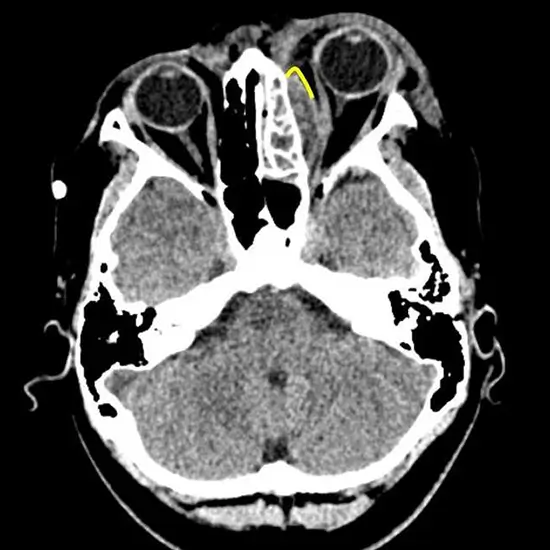 CT Head and Left Orbit | Test Price in Delhi | Ganesh Diagnostic