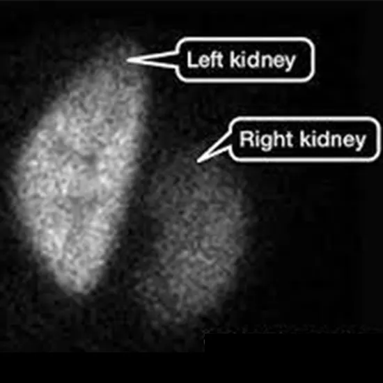 DMSA Scan Procedure in Detail - Ganesh Diagnostic