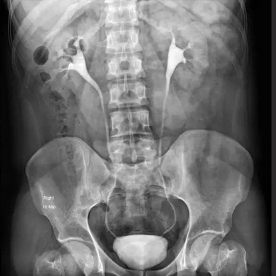 CT Scan Pyelogram Test Near Me - Yamuna Vihar - Cost - Ganesh Diagnostic