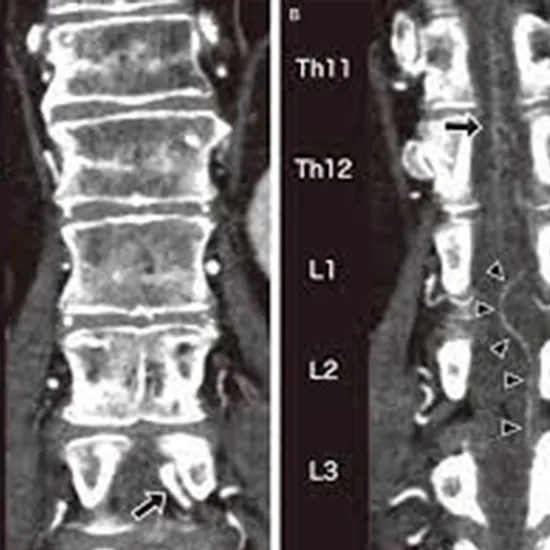 CECT Dorsal Spine Test Near me - Yamuna Vihar Price - Ganesh Diagnostic