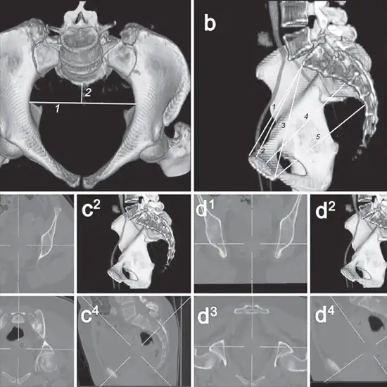 CT Pelvis 3D Test Price in Yamuna Vihar - Ganesh Diagnostic