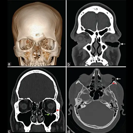 NCCT Face Axial | Test Price in Delhi | Ganesh Diagnostic