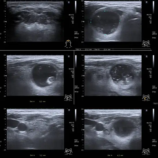 Thyroid Ultrasound Test Cost in Yamuna Vihar - Ganesh Diagnostic