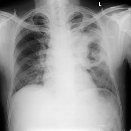 CECT Chest and HRCT Cut | Test Price in Delhi | Ganesh Diagnostic